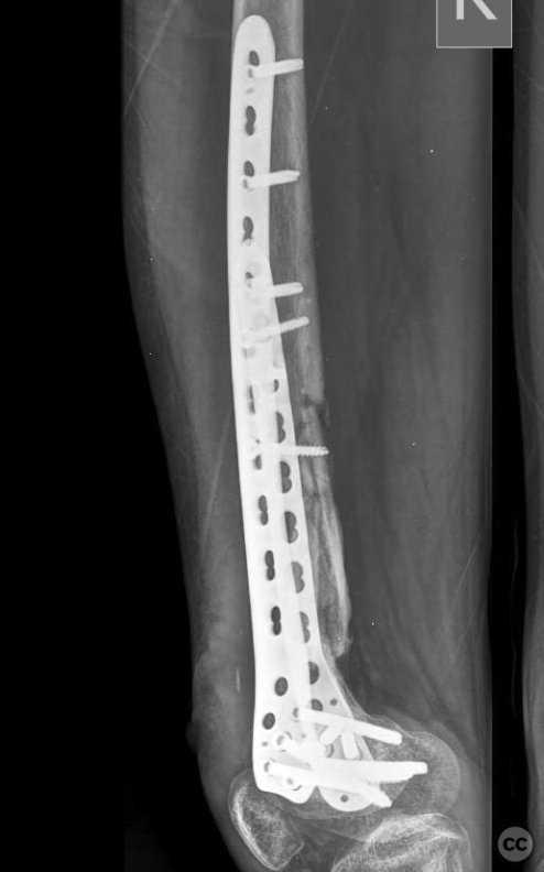 Double plate fixation of a comminuted supra- and intercondylar distal ...