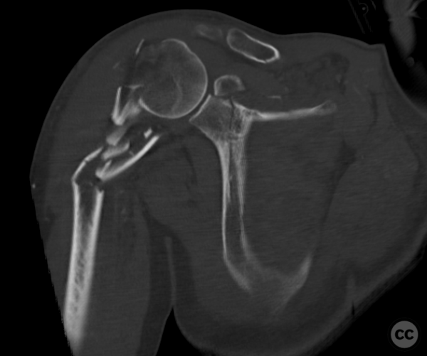 Multifragmentary Proximal Humerus Fracture with Scapula Fracture in a ...