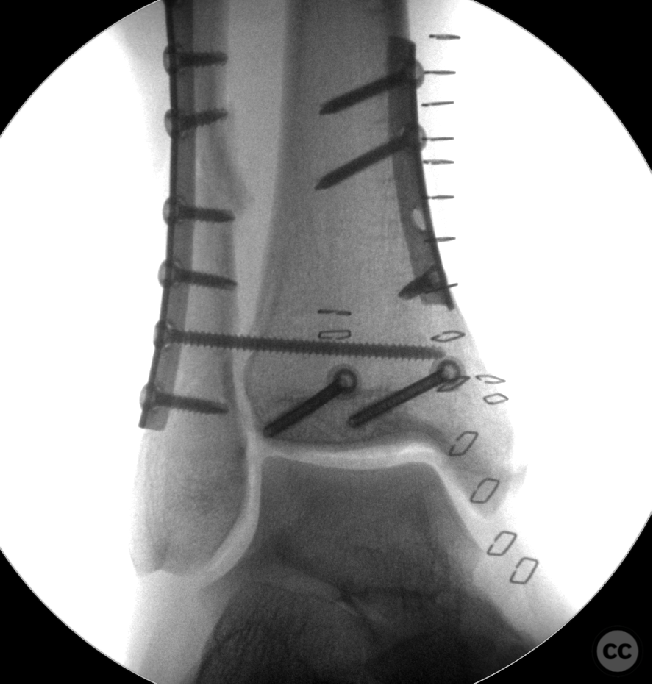 Mason III posterior malleolus fracture dislocation