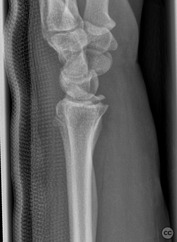 Operative Management of Chauffeur's Fracture with Intraarticular ...