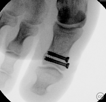 D1 prox phalanx condyle fracture