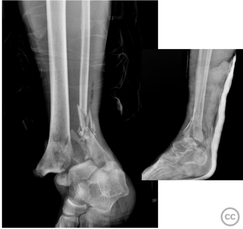 Open Medial Malleolus Fracture-Dislocation with Tibial Pilon and ...