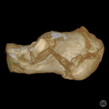 Percutaneous calcaneus screw fixation