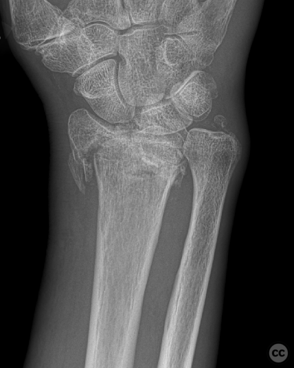 Distal Radius Fracture with Flipped Die-Punch Fragment