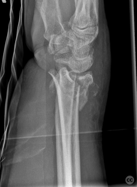 Complex comminuted and impacted distal radius fracture