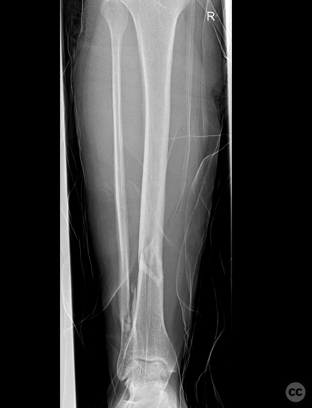 Distal 1/3 tibia shaft fracture with distal fibular fracture