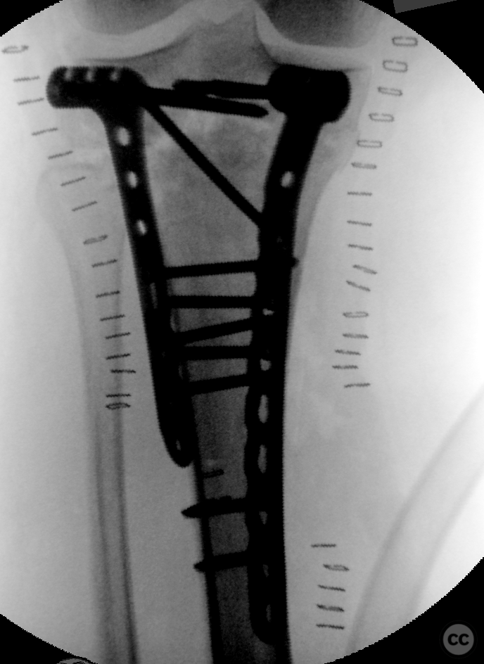 Varus hyperextension tibial plateau fracture