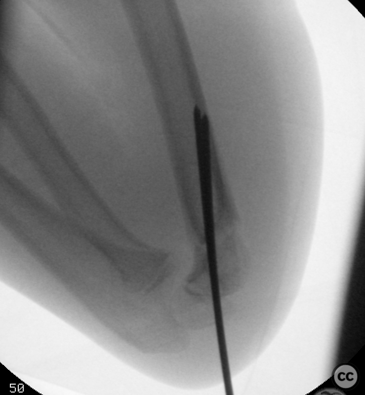 Gartland III-IV SCH fracture - closed reduction and k-wire fixation