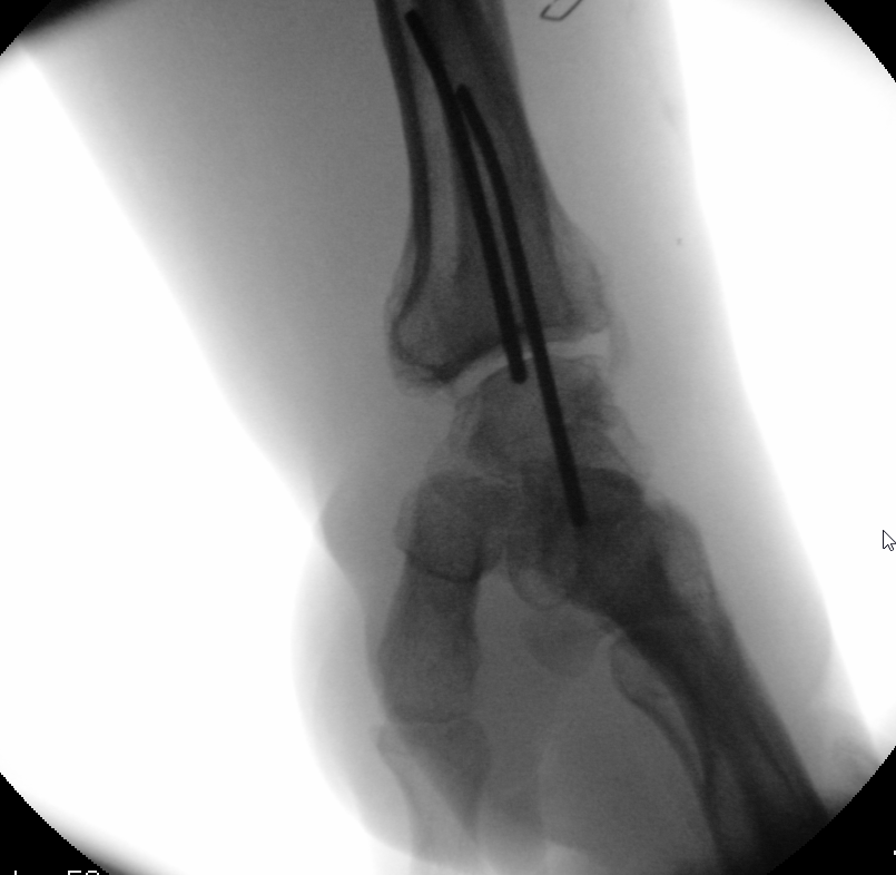 Essex-Lopresti fracture-dislocation