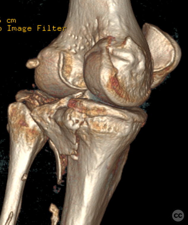 Posterolateral approach to the tibial plateau with femoral epicondylar ...