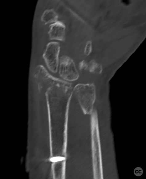 Radiocarpal distraction reduction technique for distal radius fracture