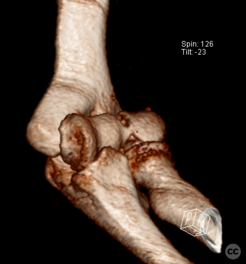Dubberly 3/4 shear plus comminuted trans condylar trochlear fracture ...