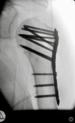 Proximal Humerus Fracture AO 11C2.2 in an Elderly Patient: ORIF with ...
