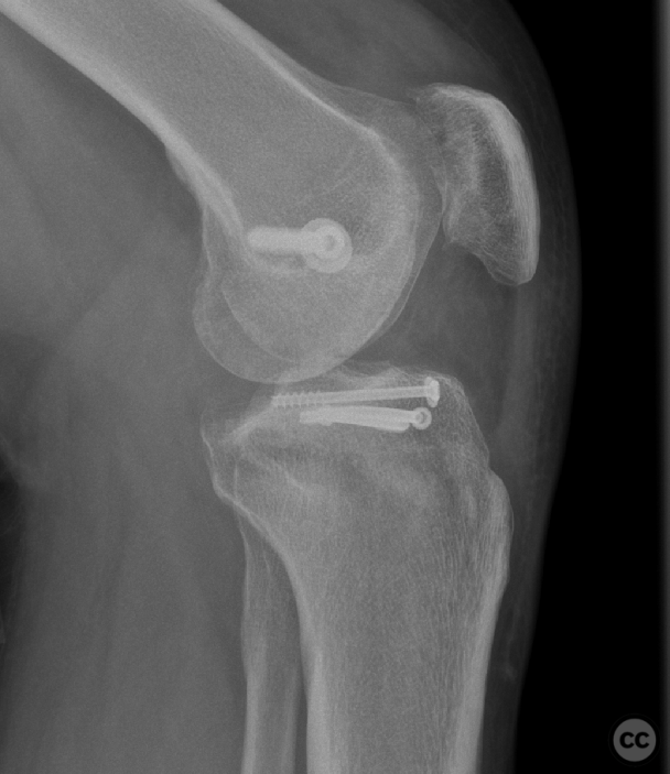 Lateral femoral epocondyle osteotomy and jail-screw fixation of the ...