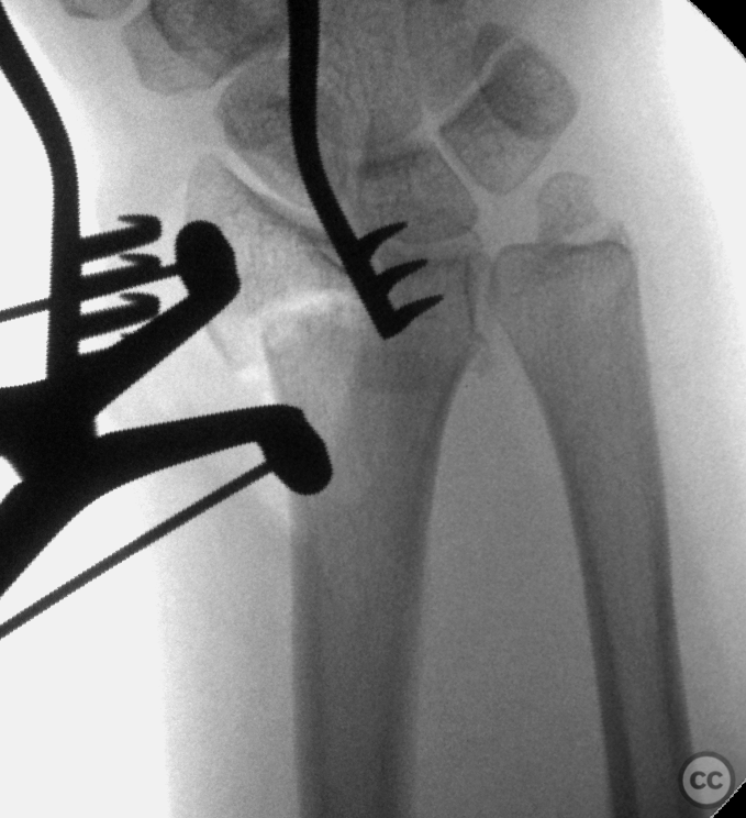 Reduction of the radial column preserving Brachioradialis using a ...