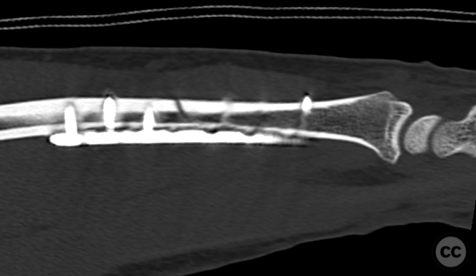 Revision of Galeazzi Fracture Dislocation with TFCC Repair and Ulnar ...