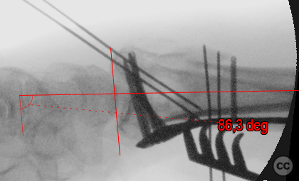 Complex comminuted and impacted distal radius fracture