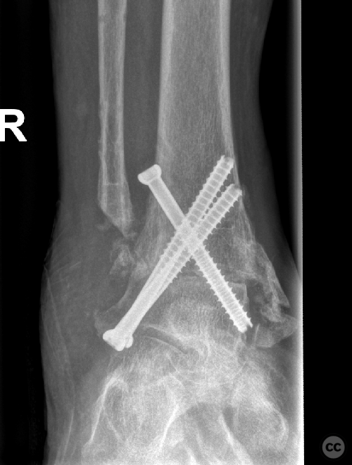 Failed pronation - external rotation (PER) ankle fracture dislocation