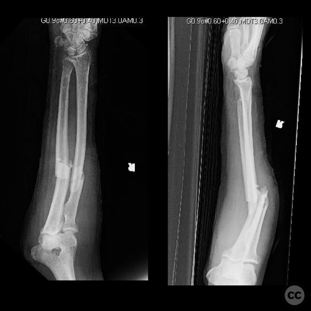 Complex Proximal Radius and Segmental Ulna Fracture Management