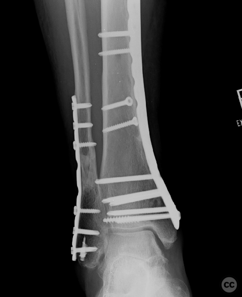 Combined distal 1/3 tibia fracture with SAD bimalleolar ankle fracture