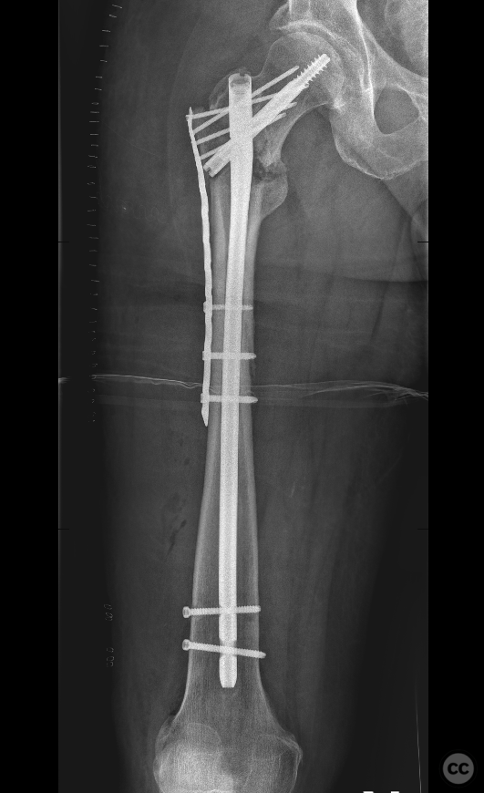Hardware Failure of Primary Gamma Nail Osteosynthesis in ...