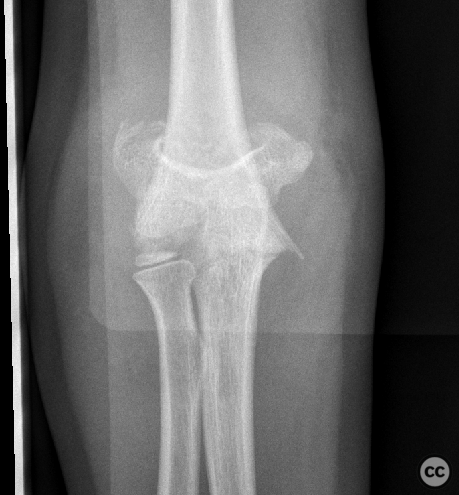 Gartland III-IV SCH fracture - closed reduction and k-wire fixation