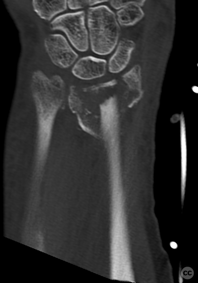 Complex comminuted and impacted distal radius fracture