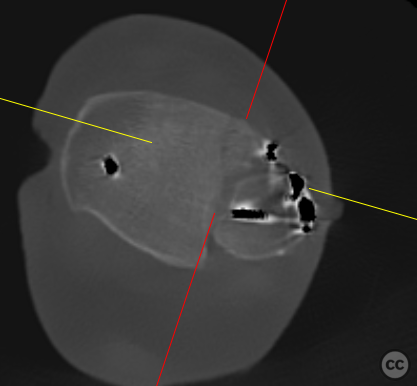 Chaput tubercle fracture in an adult bimalleolar ankle fracture