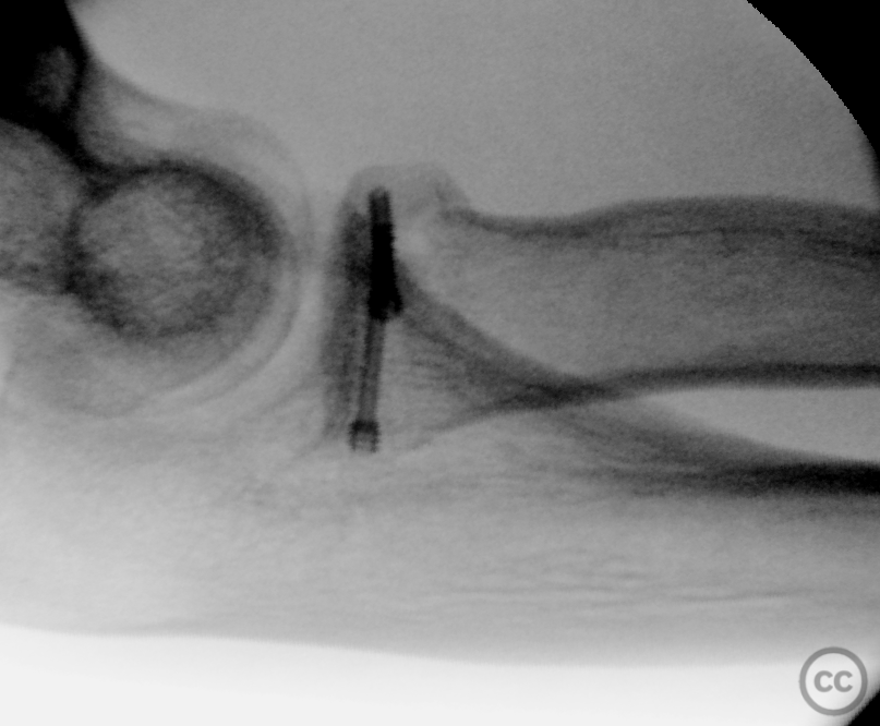 Mason II Radial Head Fracture