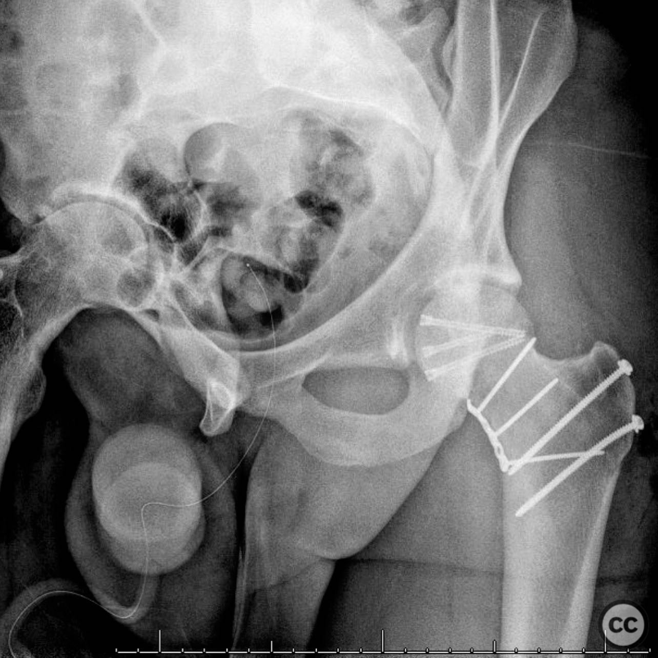 Femoral Head Fracture (Pipkin II) Treated with Surgical Dislocation ...