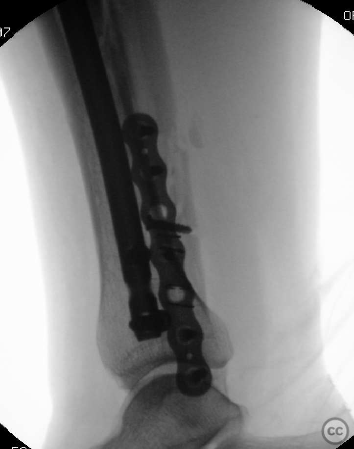 Distal 1/3 tibia shaft fracture with distal fibular fracture