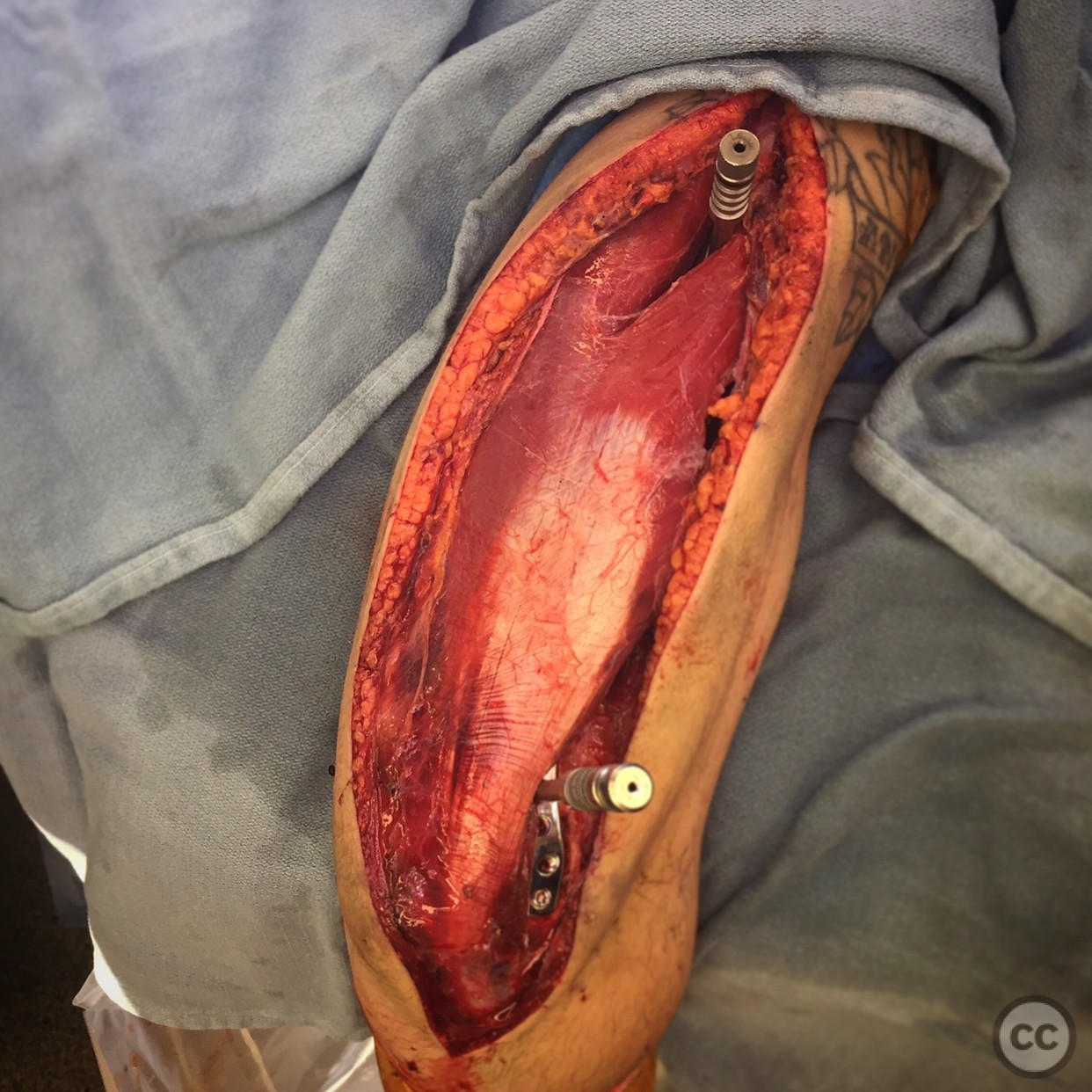 Triceps Sparing Posterior Approach for Humeral Fracture Fixation