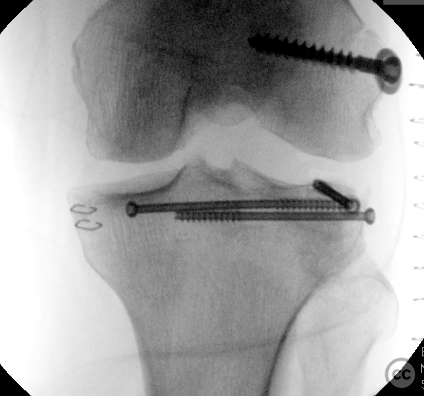 Lateral femoral epocondyle osteotomy and jail-screw fixation of the ...