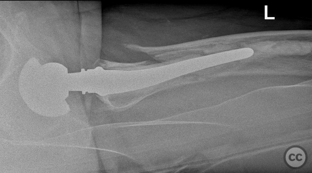 Vancouver B2 periprosthetic femur fracture - LCP broard curved