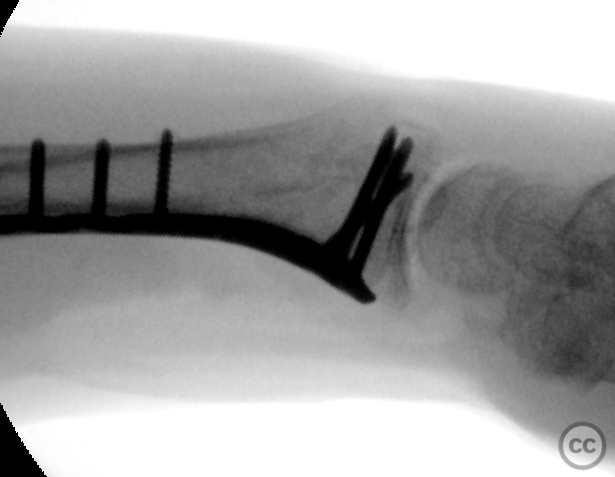 Radiocarpal distraction reduction technique for distal radius fracture