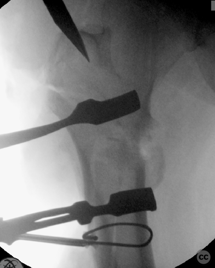 Hardware Failure of Primary Gamma Nail Osteosynthesis in ...