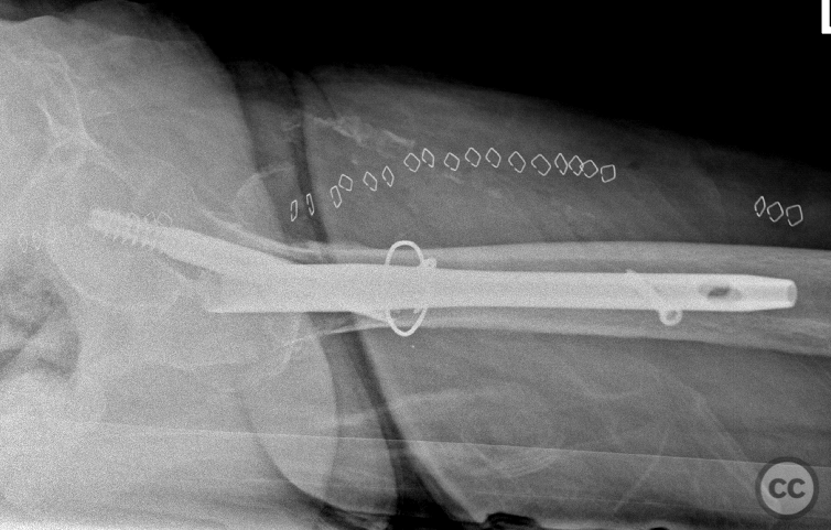 Classical intertrochanteric fracture with reverse oblique extension