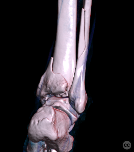 Mason III posterior malleolus fracture dislocation