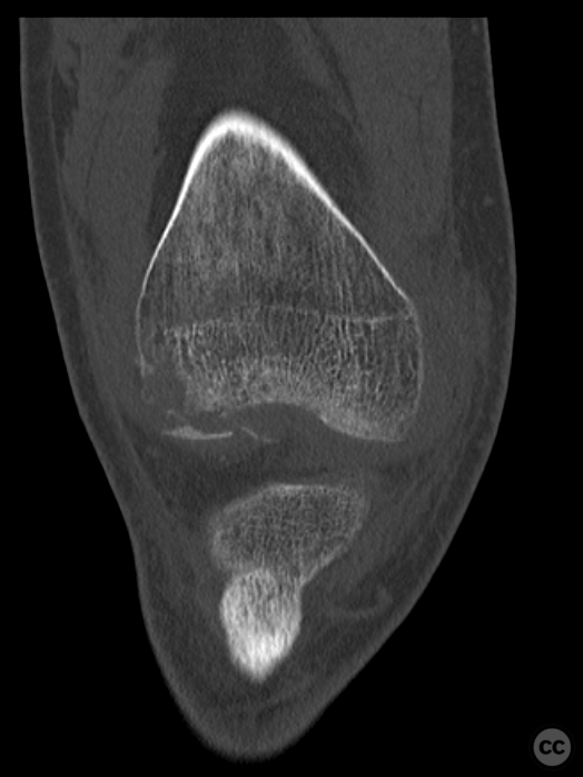 Destructive osteochondral fracture of the lateral femoral condyle ...