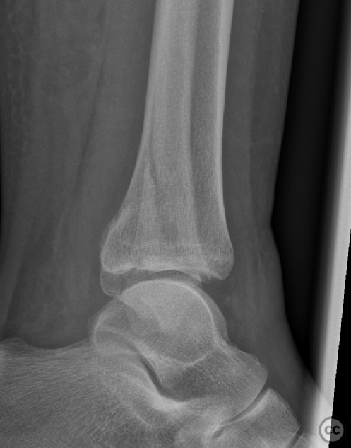 Mason IIB posterior malleolus ankle fracture
