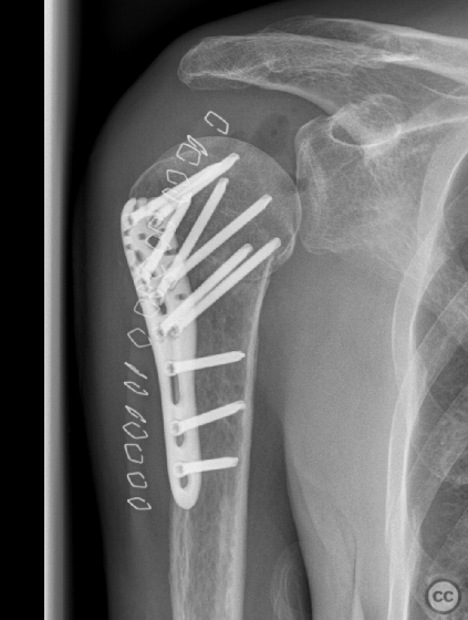 Subacute 2 part proximal humerus fracture