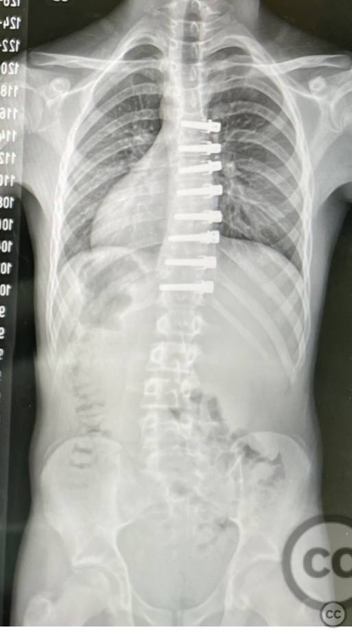 Vertebral Body Tethering for Scoliosis