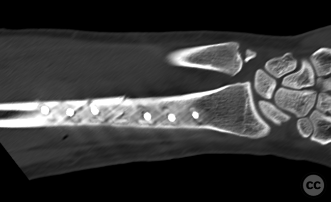 Revision of Galeazzi Fracture Dislocation with TFCC Repair and Ulnar ...