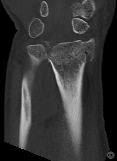Complex comminuted and impacted distal radius fracture