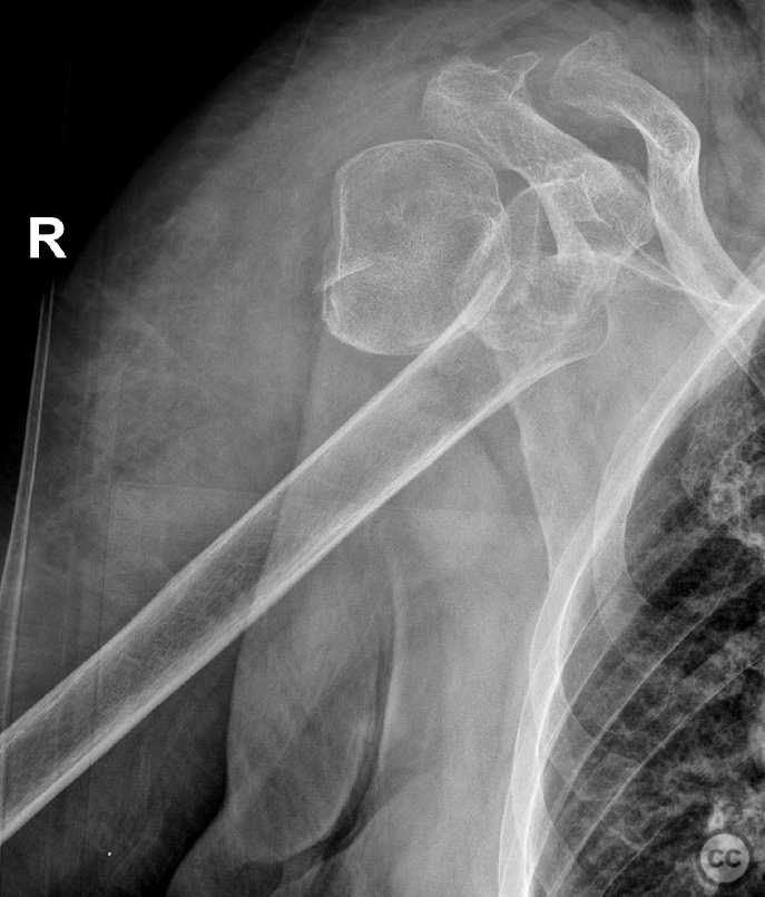 Displaced surgical neck of humerus fracture with brachial plexus ...
