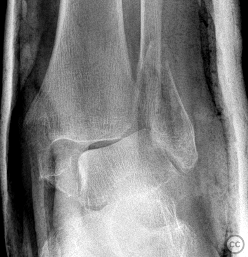 Pronation Abduction (PAb) ankle fracture with Mason 2A lateral plafond ...