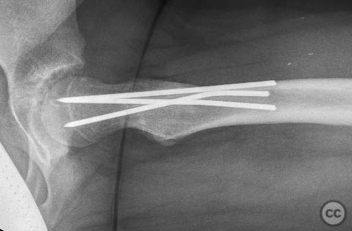 SCFE - longitudinal images over 6 years: 10-16years old
