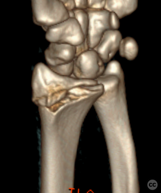 Operative Management of Chauffeur's Fracture with Intraarticular ...