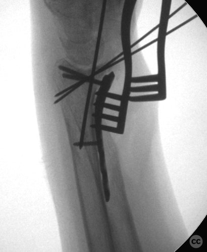 Volar Barton's volar rim fracture distal radius