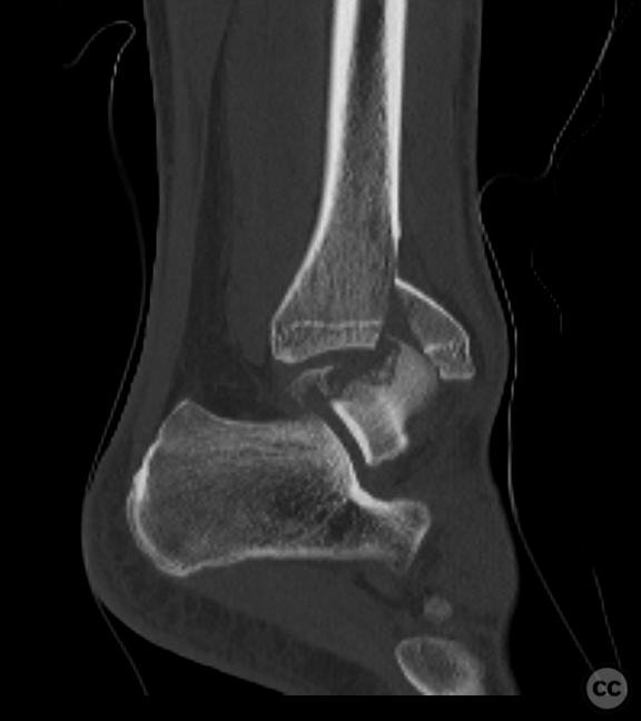 Anterior fracture dislocation with impression fracture of the articular ...